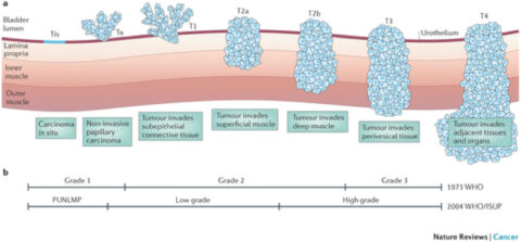 Bladder Cancer - Urology Waikato