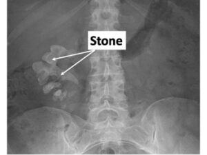 Kidney Stones - Urology Waikato